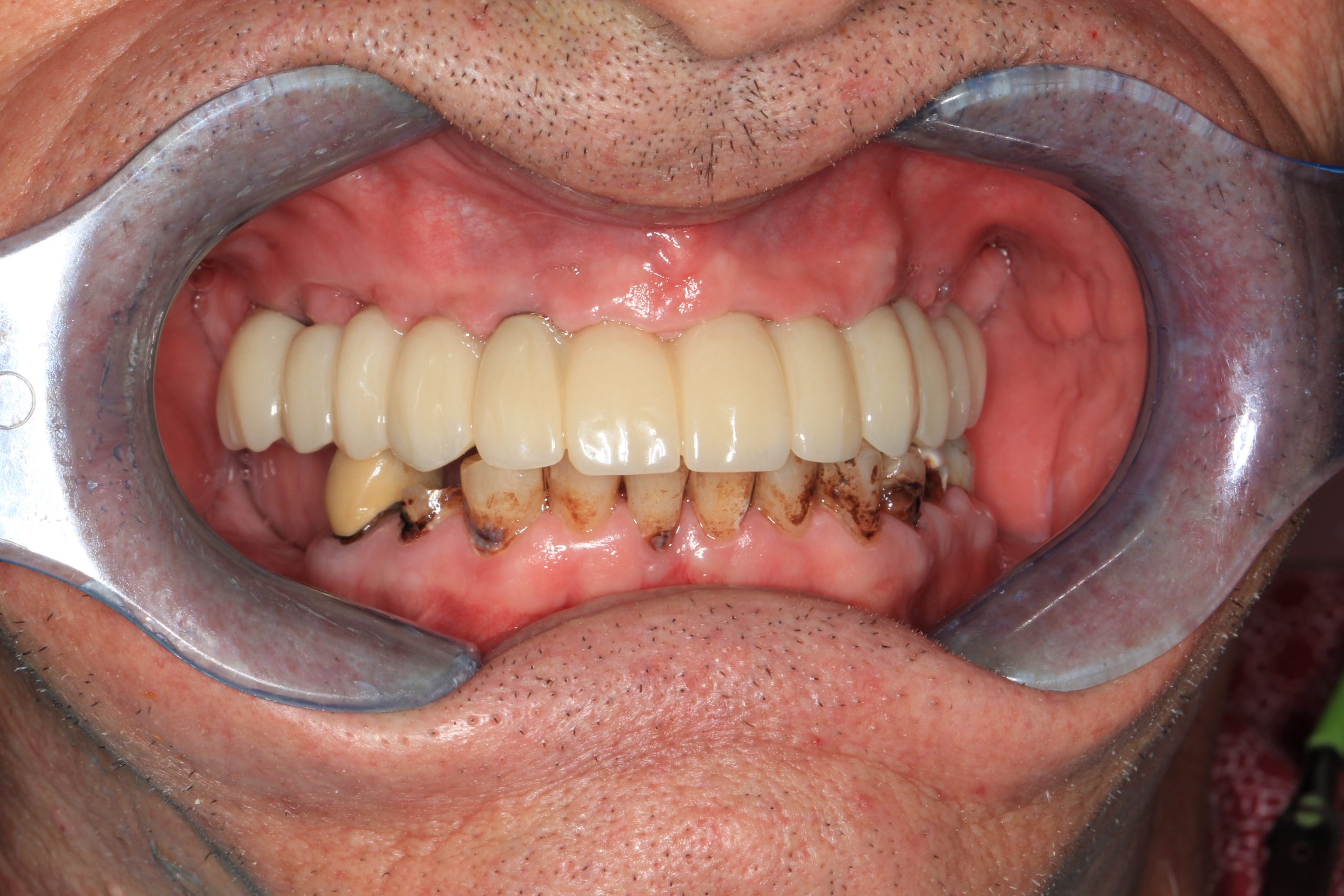 All On 4 - Murdoch Dental & Implant Centre